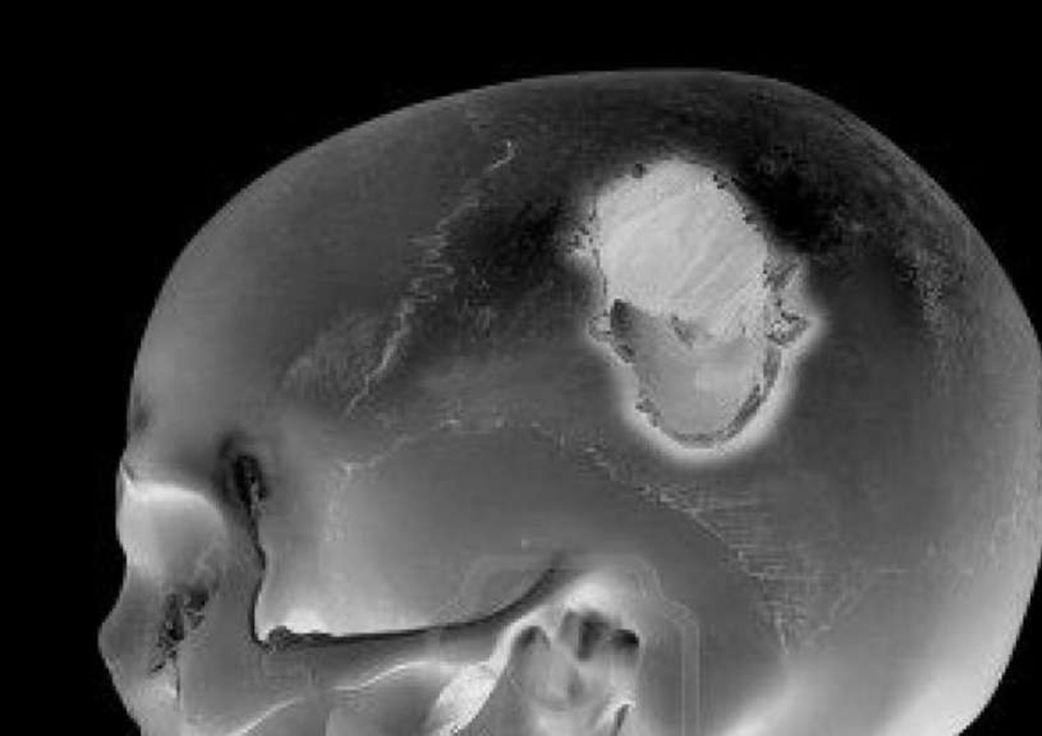 Trauma cranico lieve puo' causare danni cerebrali
