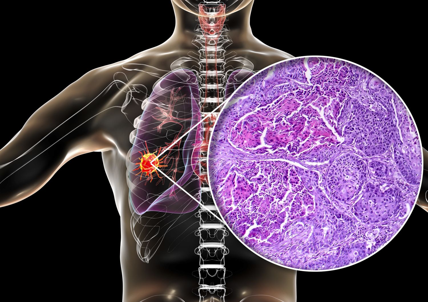 Una diagnosi più precisa per prevedere il cancro al polmone tra i fumatori