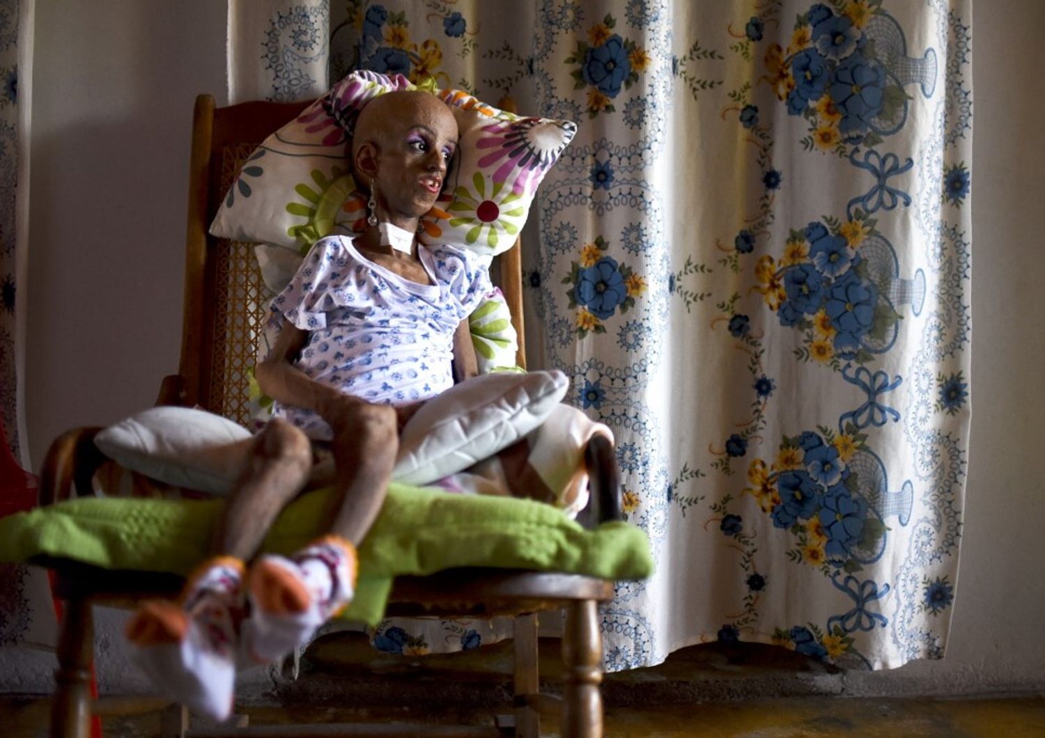 Cos'è la progeria di Hutchinson-Gilford, la malattia di Sammy Basso
